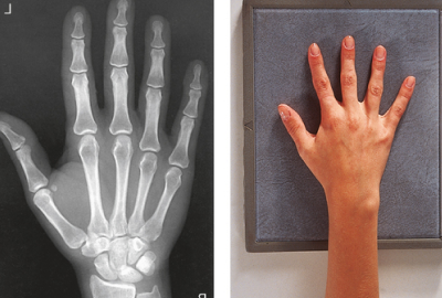 Xray Hand Ap And Oblique View Of The Involved Left Hand Distal Radius